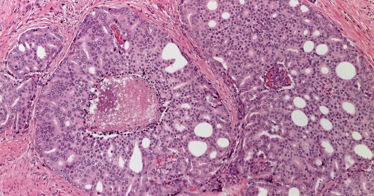 Cancro da Próstata: o que é, sintomas e tratamento | CUF