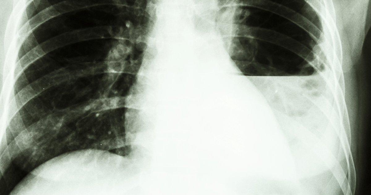 Raio X De Abscesso Pulmonar