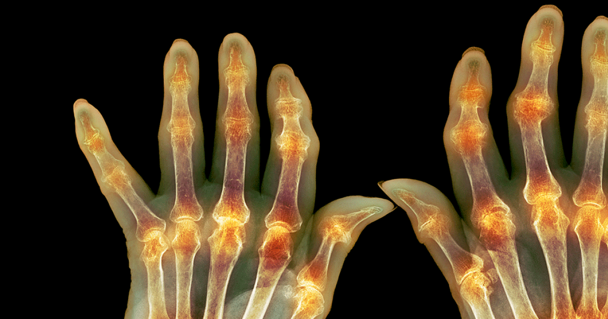 Artrite inflamatória: o que é, sintomas e tratamento | CUF
