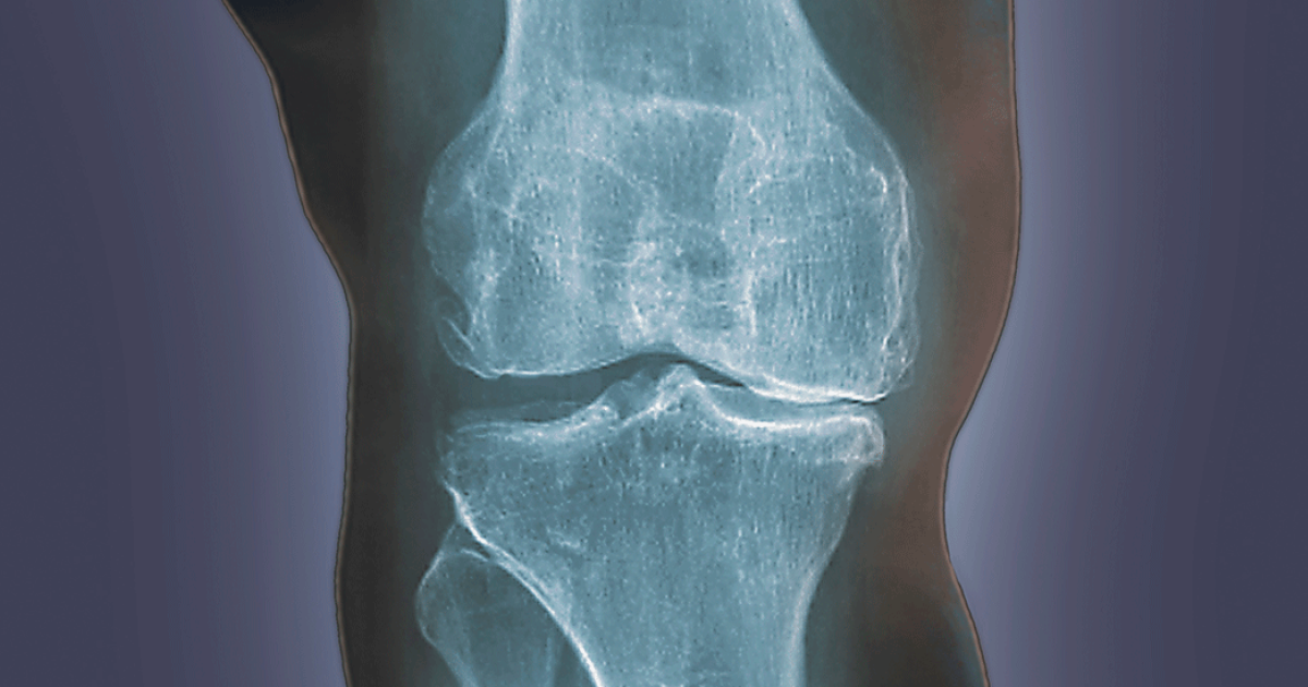 Artrose: o que é, sintomas e tratamento | CUF