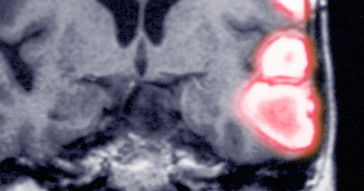 AVC - Acidente Vascular Cerebral: o que é, sintomas e tratamento | CUF