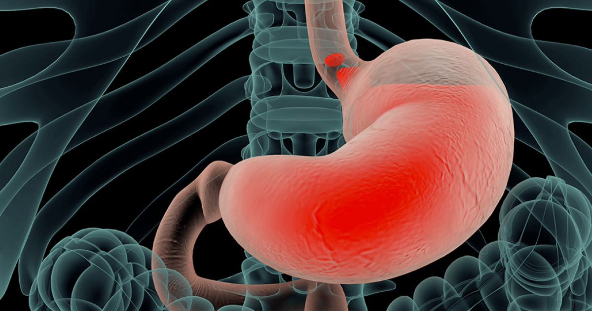 Azia: causas, diagnóstico e tratamento | CUF