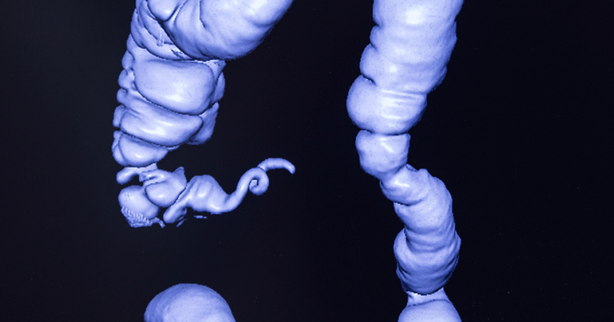 Colite ulcerosa: o que é, sintomas e tratamento | CUF