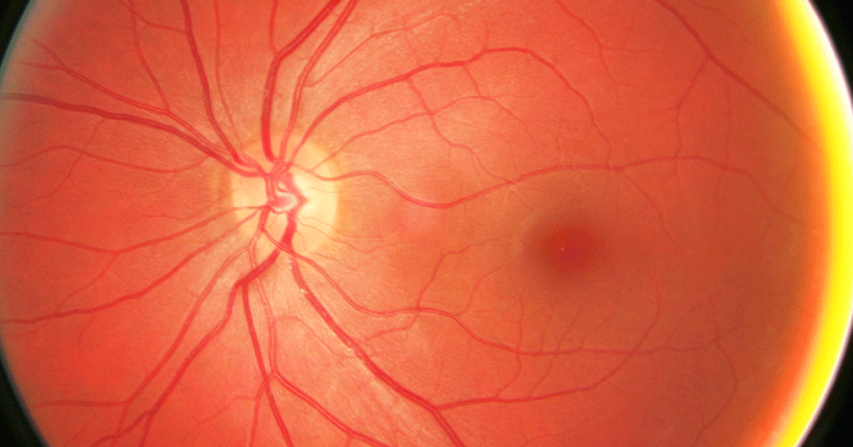 Degenerescência Macular da Idade (DMI): o que é, sintomas e tratamento ...