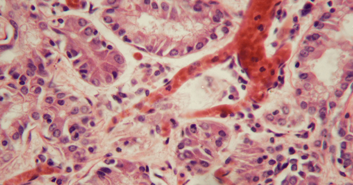 Embolia pulmonar: o que é, sintomas e tratamento | CUF