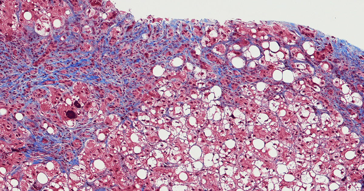 Histologia De Cirrose Hepatica Alcoolica