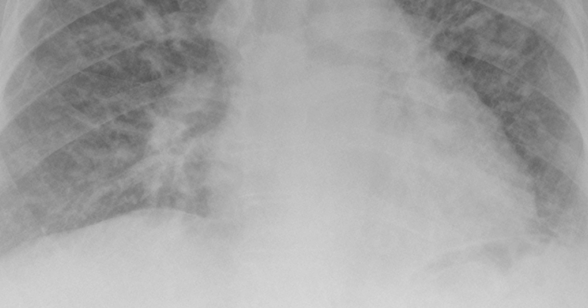 Fibrose pulmonar: o que é, sintomas e tratamento | CUF