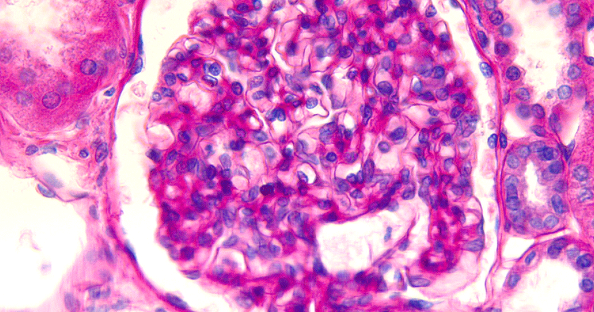 Glomerulonefrite | CUF