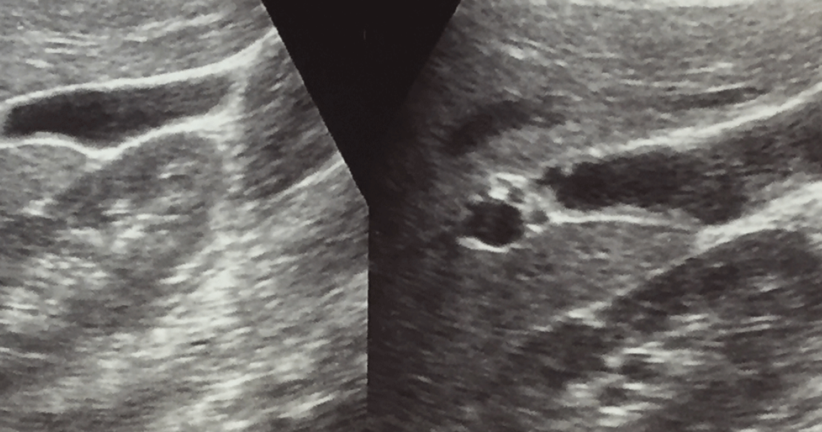 Litíase da vesícula biliar | CUF