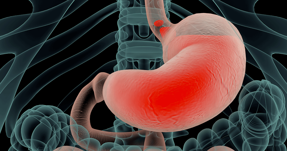 Refluxo gastroesofágico: o que é, sintomas e tratamento | CUF