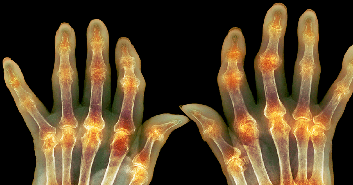 Reumatismo: o que é, sintomas e tratamento | CUF