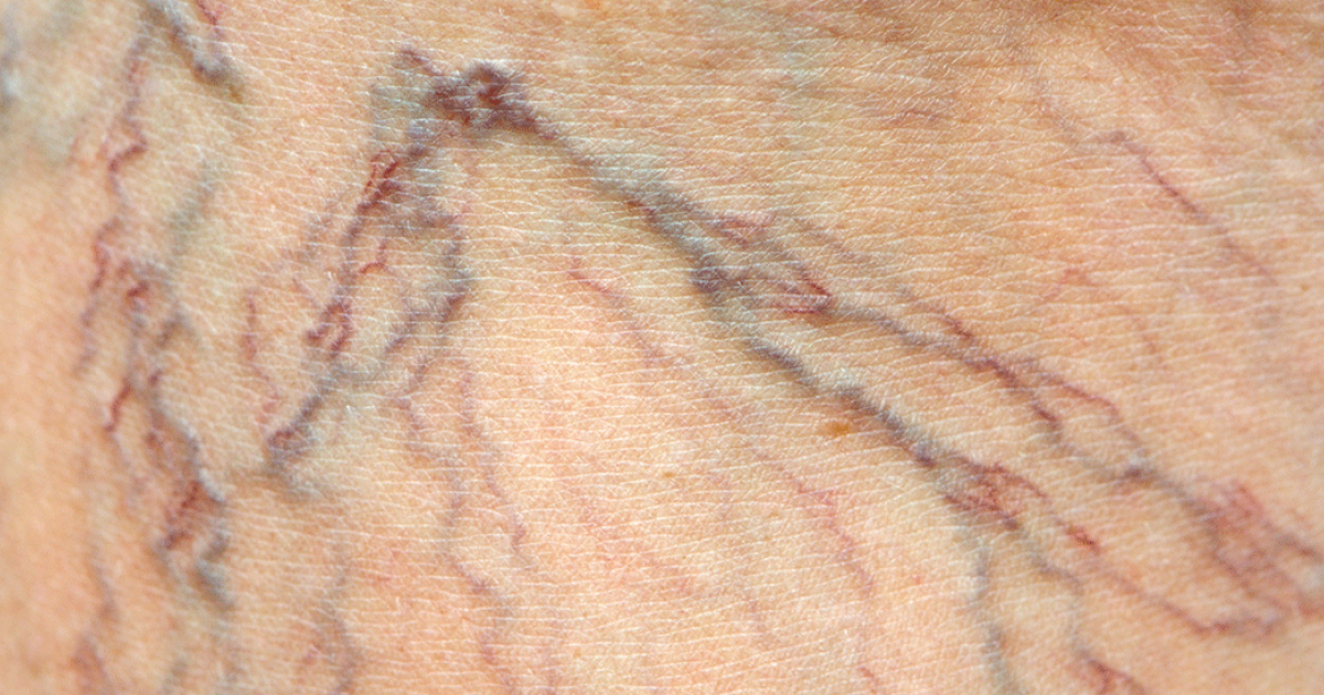 Varizes: o que é, sintomas e tratamento | CUF