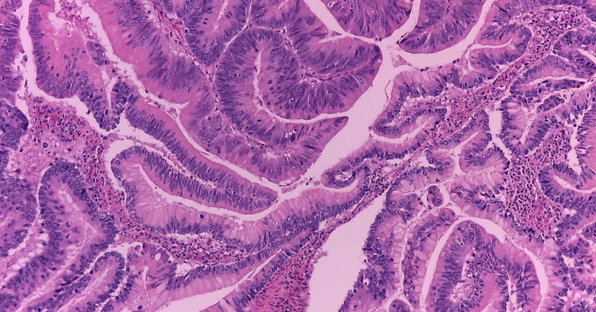 Cancro do Cólon e Reto: o que é, sintomas e tratamento | CUF