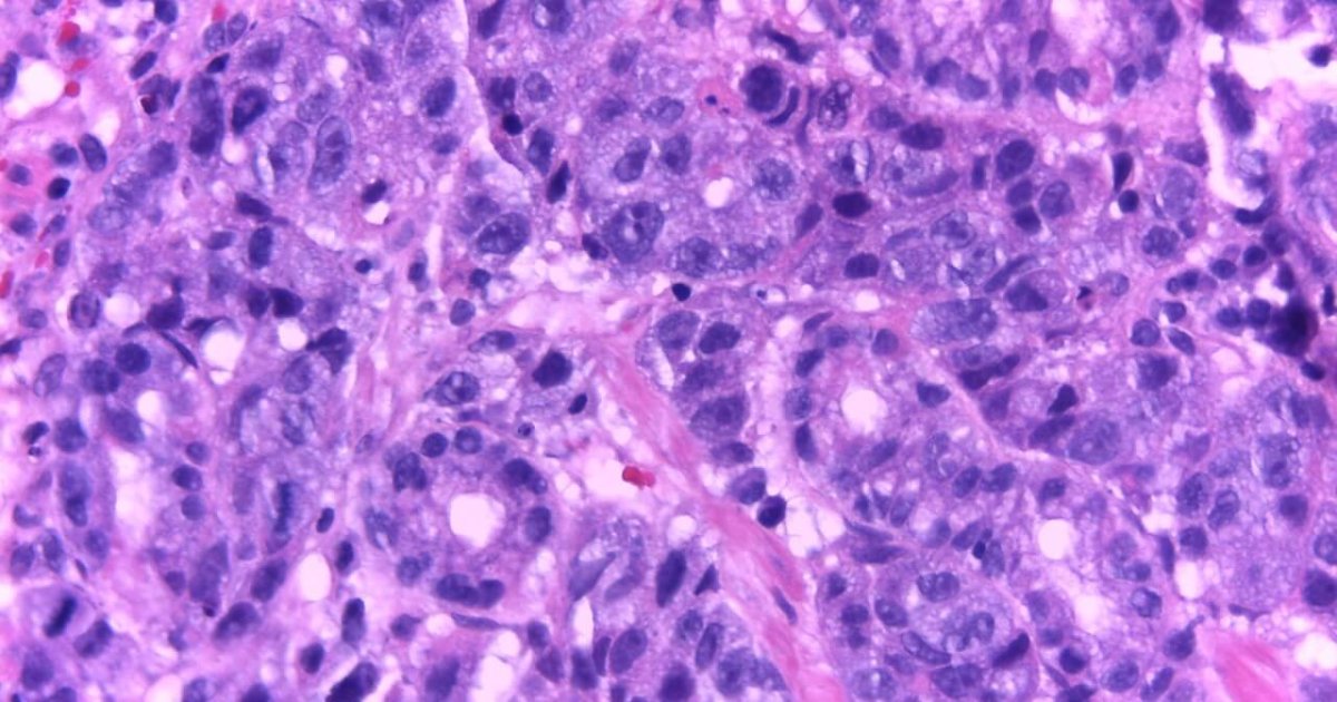 Cancro do Esófago: o que é, sintomas e tratamento | CUF