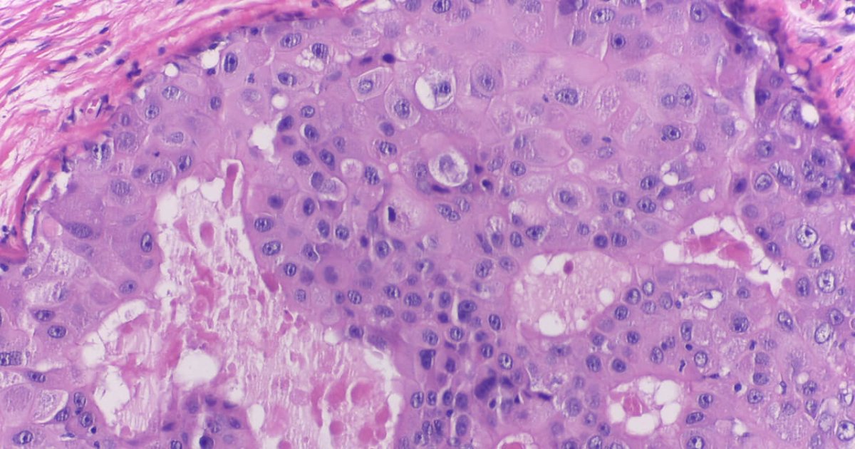 Cancro da Mama: o que é, sintomas e tratamento | CUF