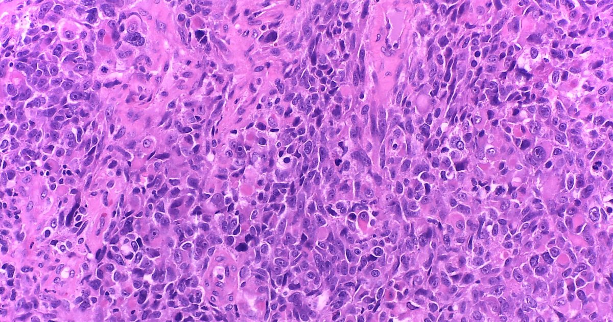 Cancro do Ovário: o que é, sintomas e tratamento | CUF