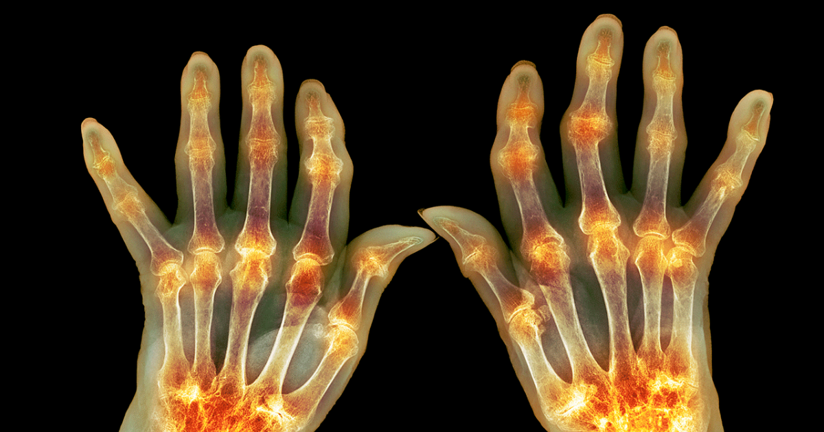 Artrite reumatoide: o que é, sintomas e tratamento | CUF
