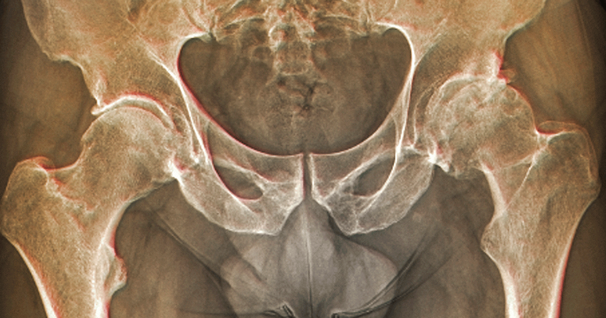 Coxartrose é Doença Degenerativa - BRAINCP