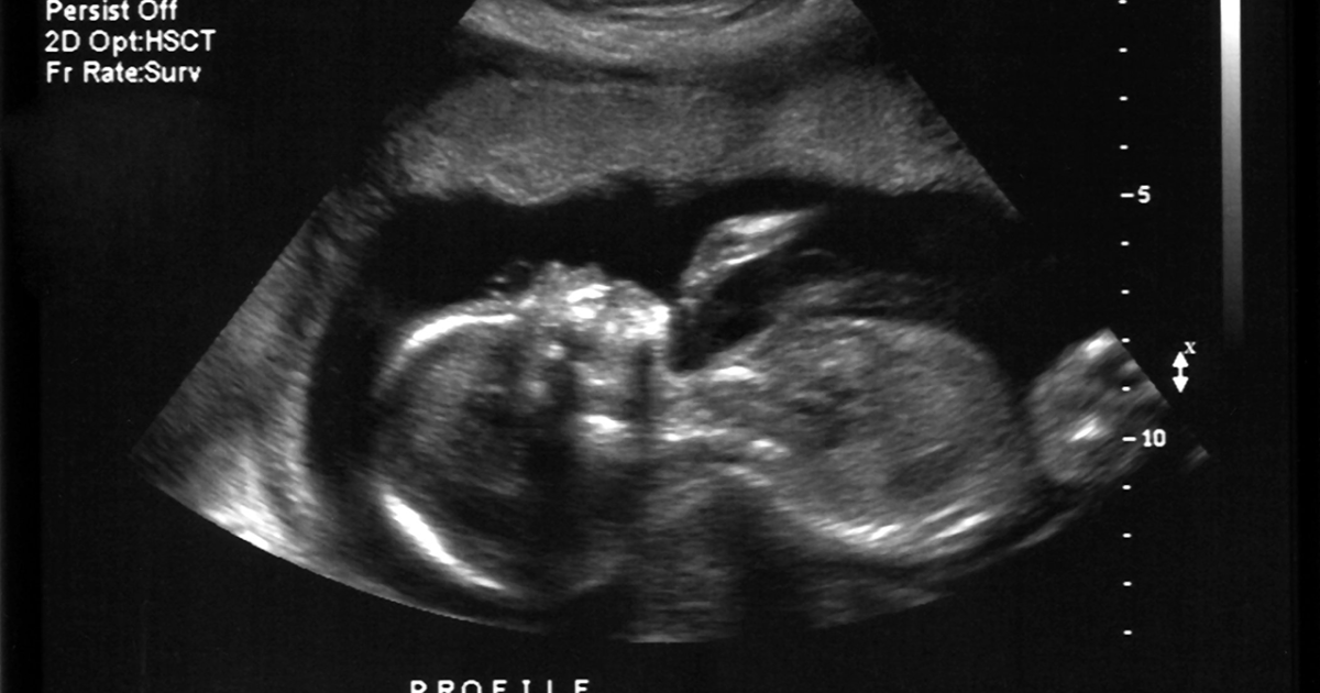 Espinha bífida: o que é, sintomas e tratamento | CUF