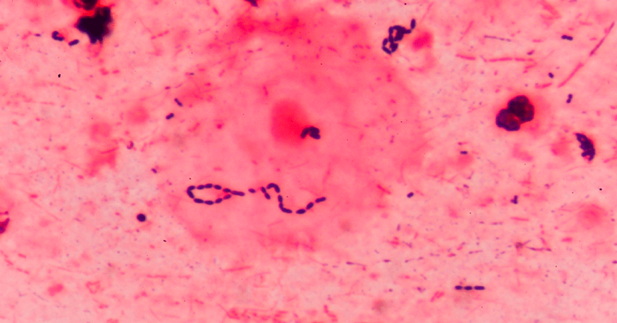 Faringite: o que é, sintomas e tratamento | CUF