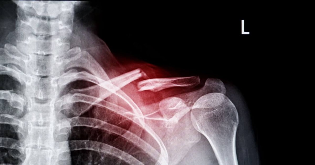 Fratura Patologica Pathological Fracture Of The Jaw Due To