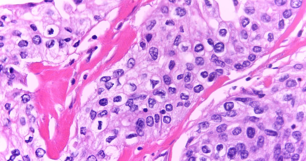 Cancro do Colo do Útero: o que é, sintomas e tratamento | CUF