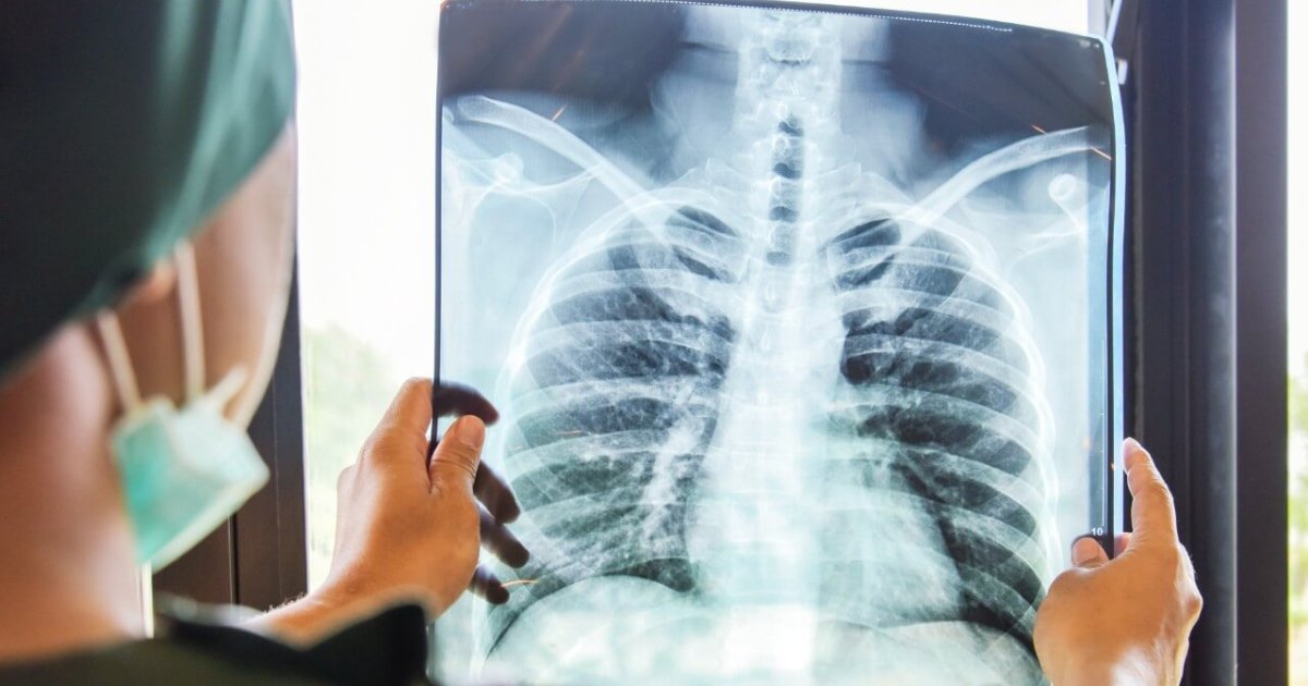 Pectus Excavatum: o que é, sintomas e tratamento | CUF