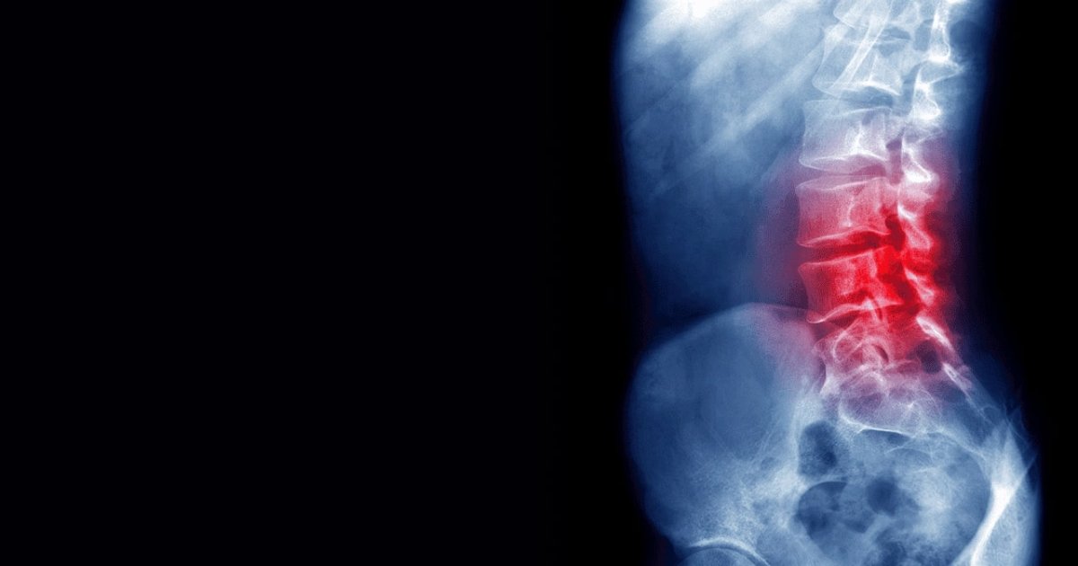 Discopatia: o que é, sintomas e tratamento | CUF