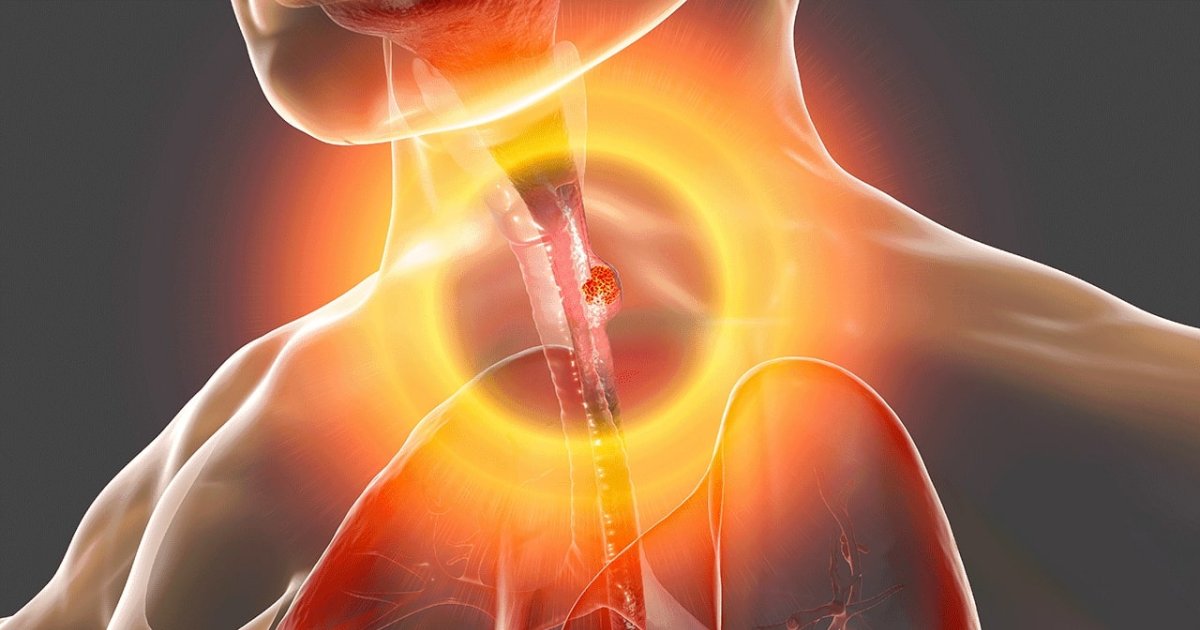 Disfagia: causas, diagnóstico e tratamento | CUF