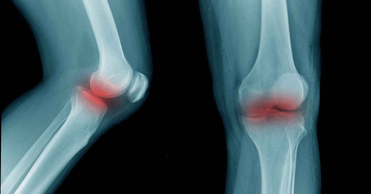 Instabilidade rotuliana: o que é, sintomas e tratamento | CUF