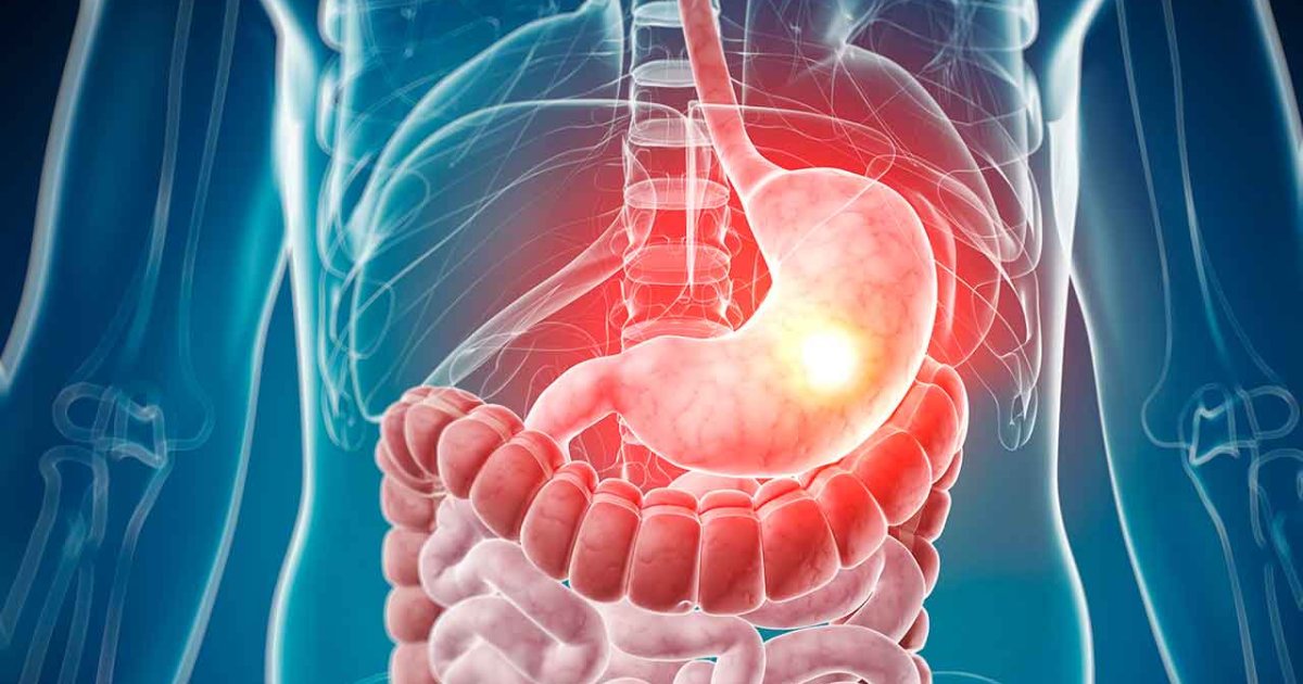 Intolerância alimentar: o que é, sintomas e tratamento | CUF