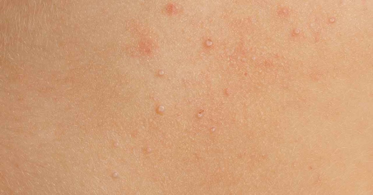 Molusco contagioso: o que é, sintomas e tratamento | CUF