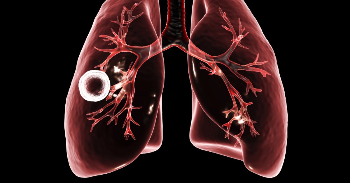 Tuberculose: o que é, sintomas e tratamento | CUF