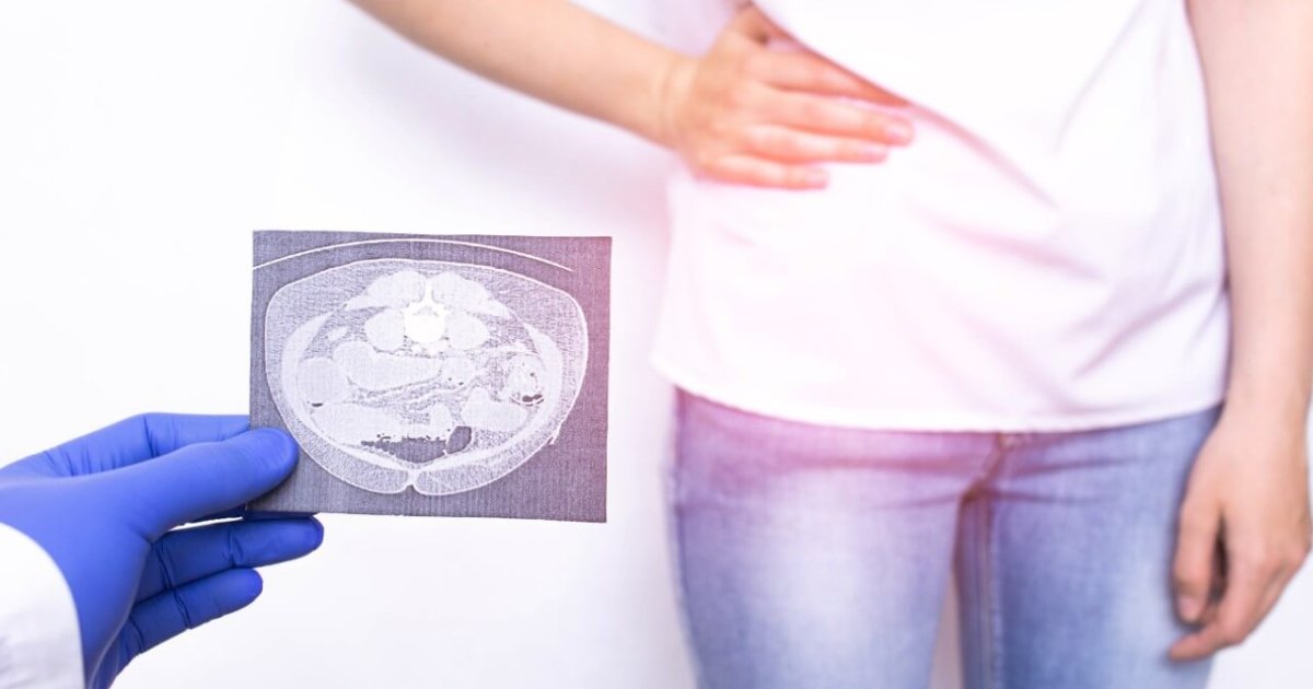 Apendicite: o que é, sintomas e tratamento | CUF