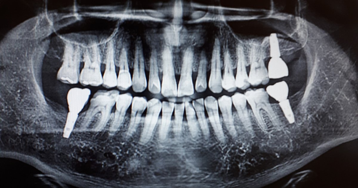 Doenca Periodontal Avancada Antes E Depois Extrair Dente Infeccionado
