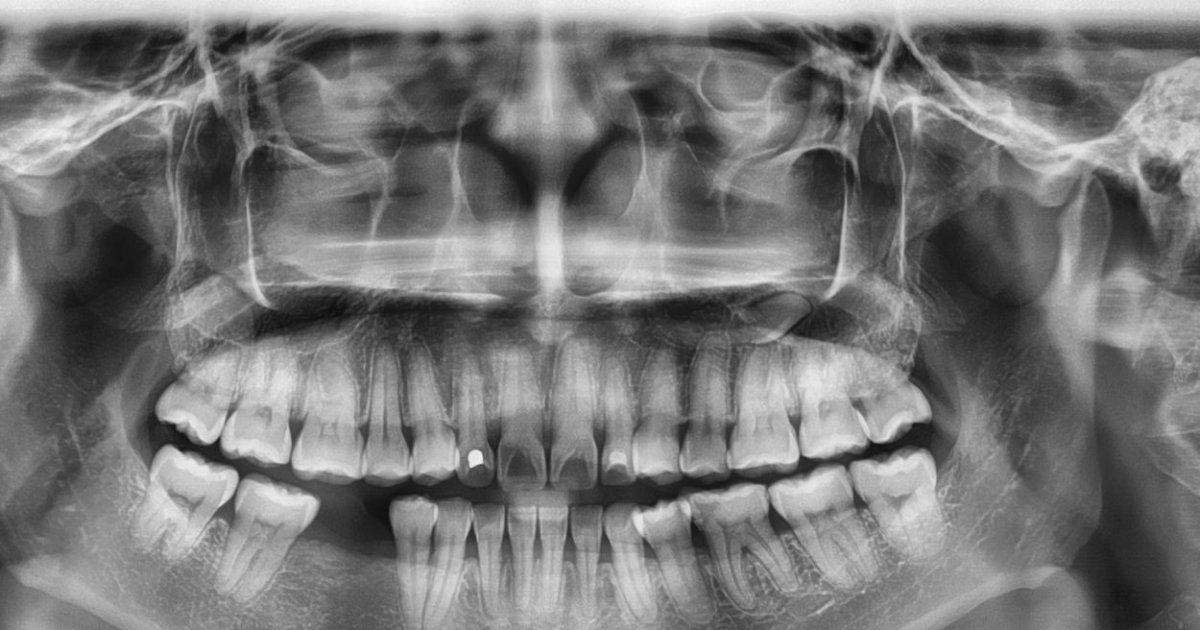 Alveolite dentária | CUF