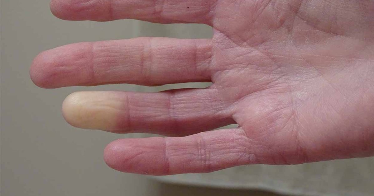 Síndrome de Raynaud: o que é, sintomas e tratamento | CUF