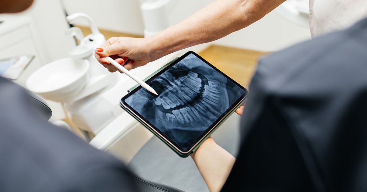 Dentes do siso: devemos sempre “arrancá-los”? | CUF