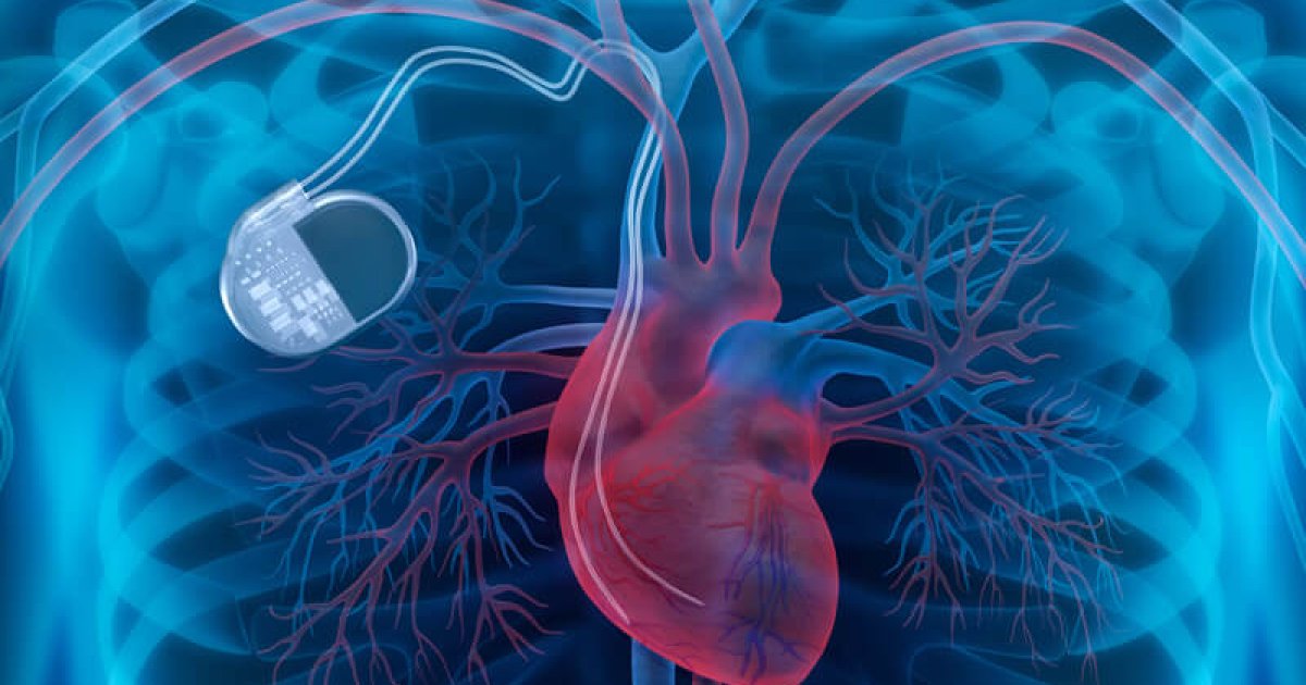 Curso de Pacing | CUF