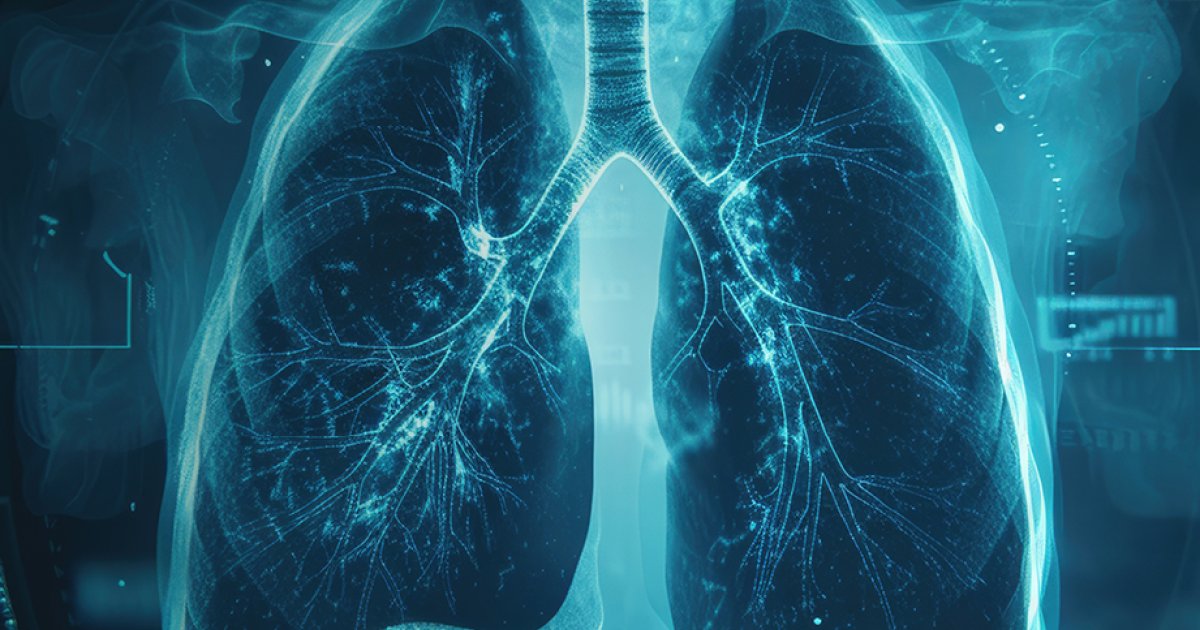 Update in Pulmonary Thromboembolic Disease | CUF