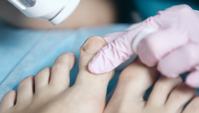 Panarício: o que o provoca e como resolver? | CUF